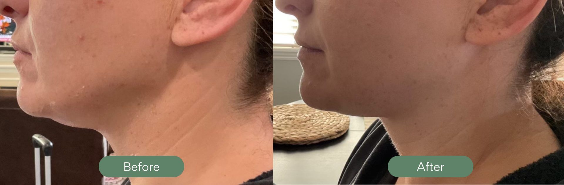 KYBELLA® - Injected Artistry