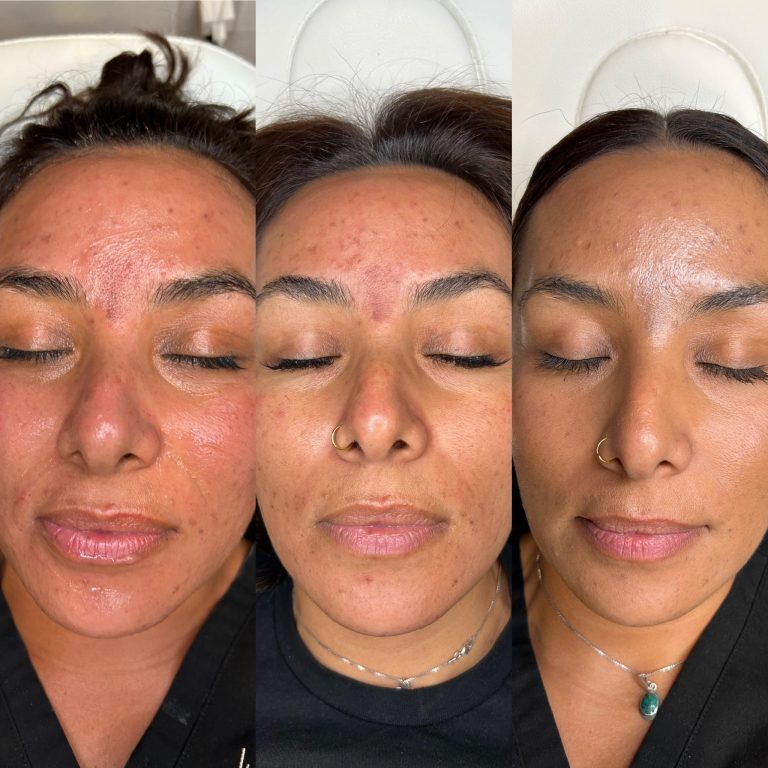 Microneedling - Injected Artistry